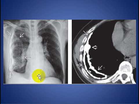 Pleural Calcification - YouTube