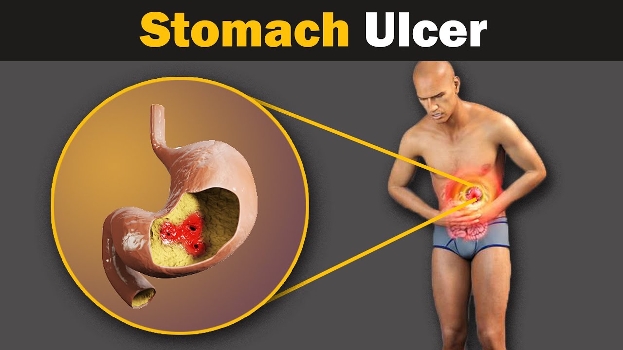 What Causes A Stomach Ulcer Animation YouTube what-causes-a-stomach-ulcer-animation-youtube