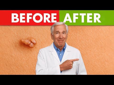 Remove Skin Tags & Warts Overnight – Simple Natural Method
