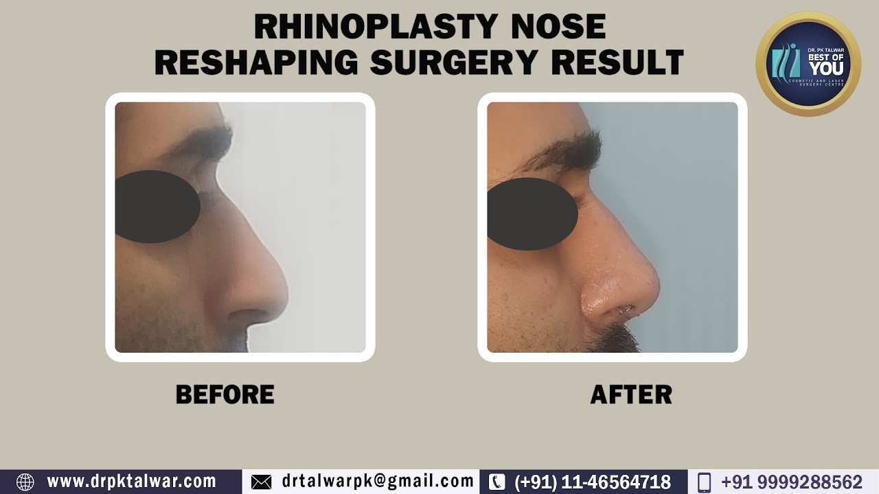 Rhinoplasty Surgery Procedure and Results, Nose Reshaping Surgery in Delhi By Dr. PK Talwar ...