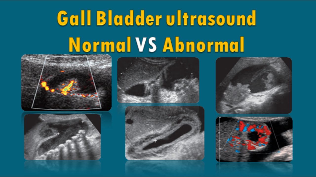 Sonographic Appearances of Gallbladder Pathologies || Radiology cases ...