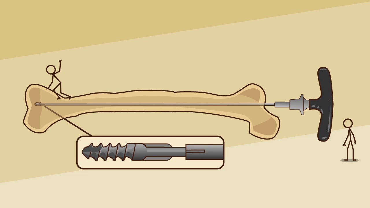 Fassier-Duval Rescue System - By Pega Medical - YouTube