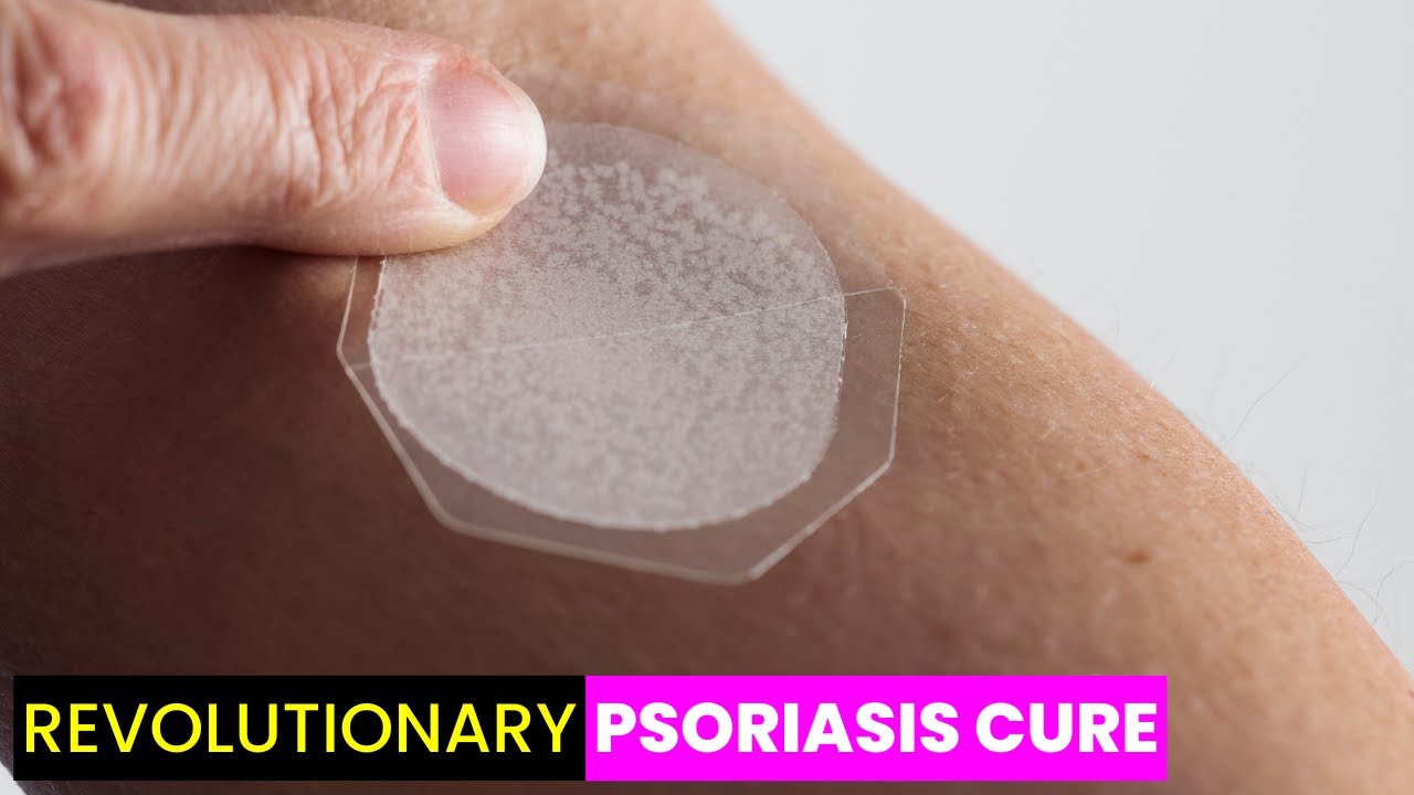 New Psoriasis Treatment Patch | Future Technology & Science News 458 ...