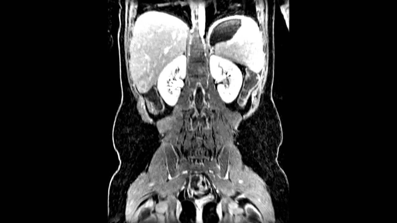 Isotropic volumetric T1 Dixon MRI of the bowel at 3.0 Tesla - YouTube