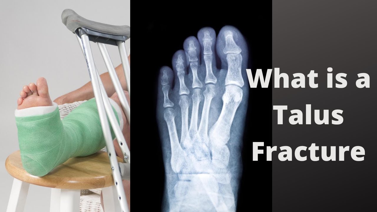 What is a Talus Fracture - YouTube