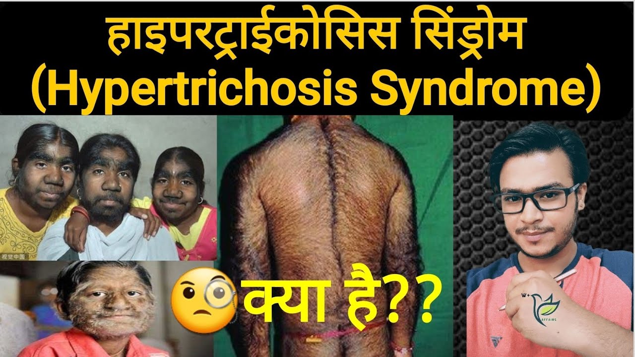 What is "Hypertrichosis Syndrome"?, भेड़िया वाली बीमारी, Werewolf Syn ...