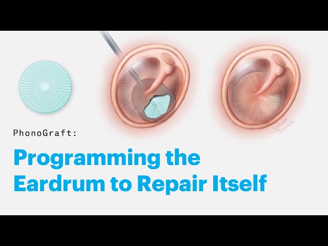 Can An Eardrum Repair Itself