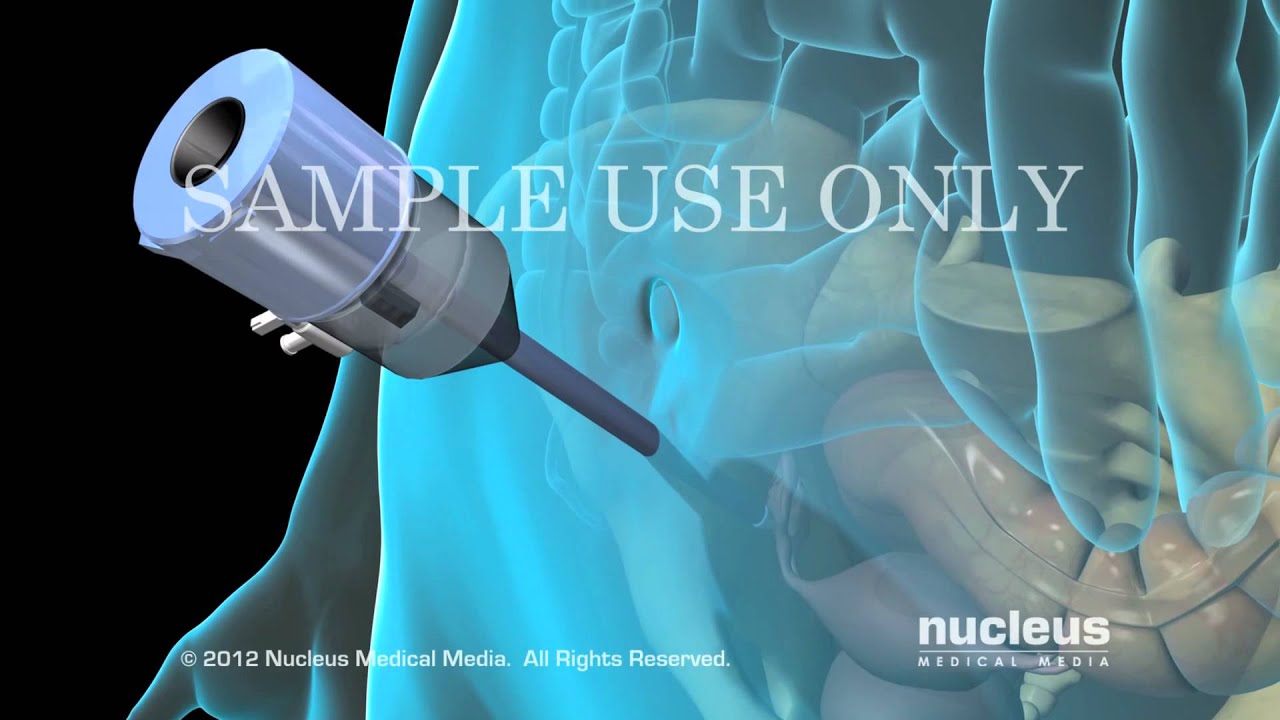 Laparoscopia pélvica diagnóstica - YouTube