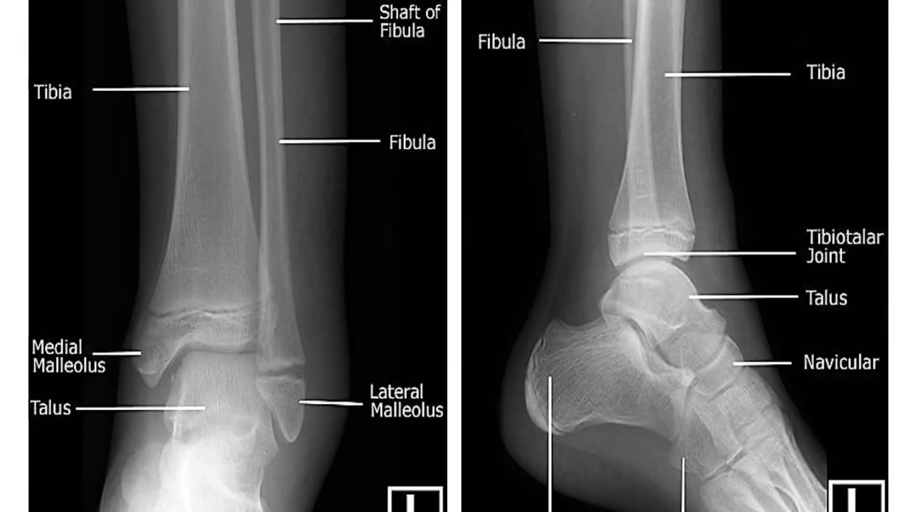 Age Estimation From Ankle X ray YouTube age-estimation-from-ankle-x-ray-youtube