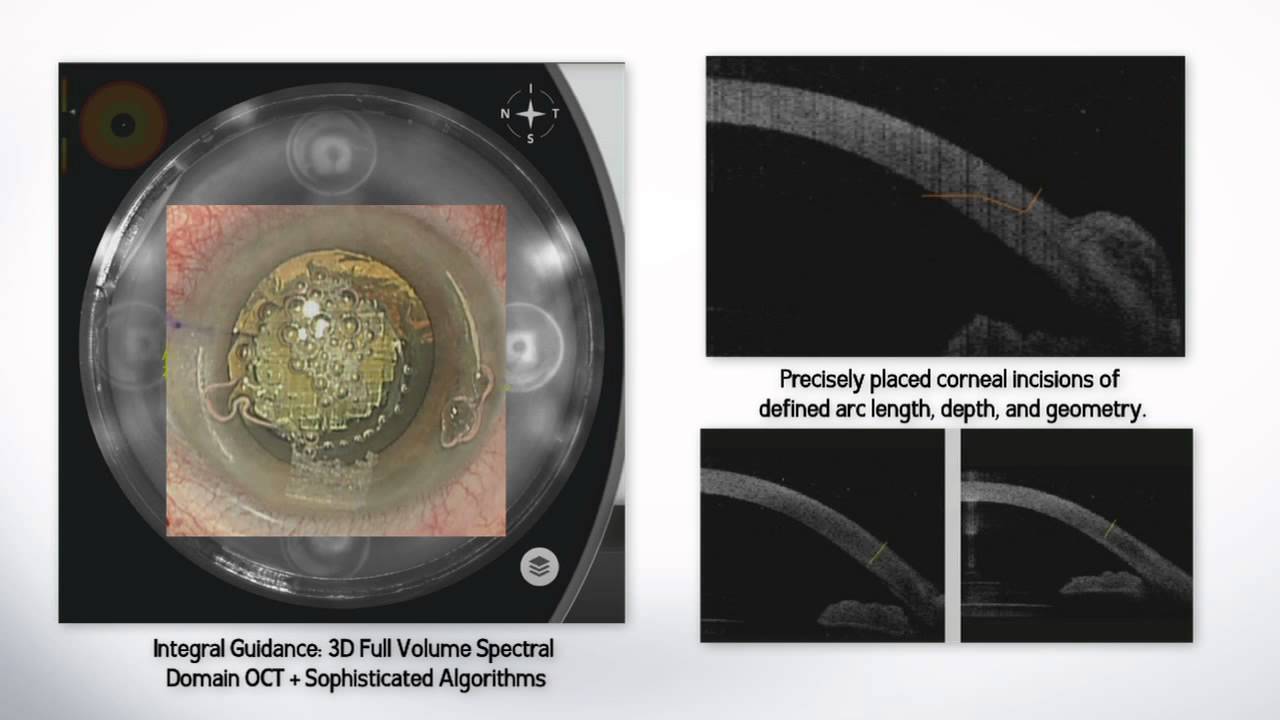 Catalys Surgeon Testimonials - Laser Cataract Surgery with Catalys ...