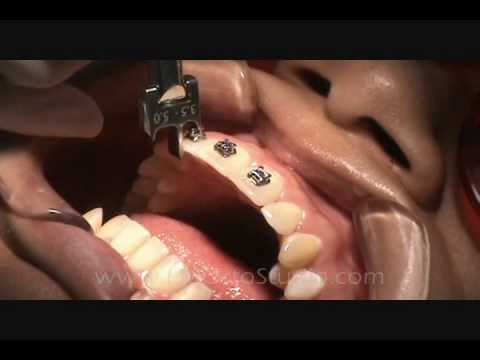 Adhesión de brackets autoligables BioQuick LMOrtoStudio.wmv - YouTube