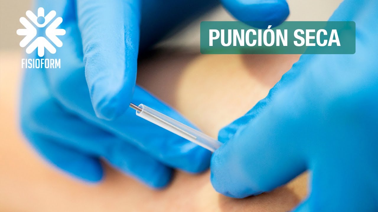 ¿QUÉ ES LA PUNCIÓN SECA? 📌 ¿CUÁLES SON SUS EFECTOS? 🤔 - YouTube