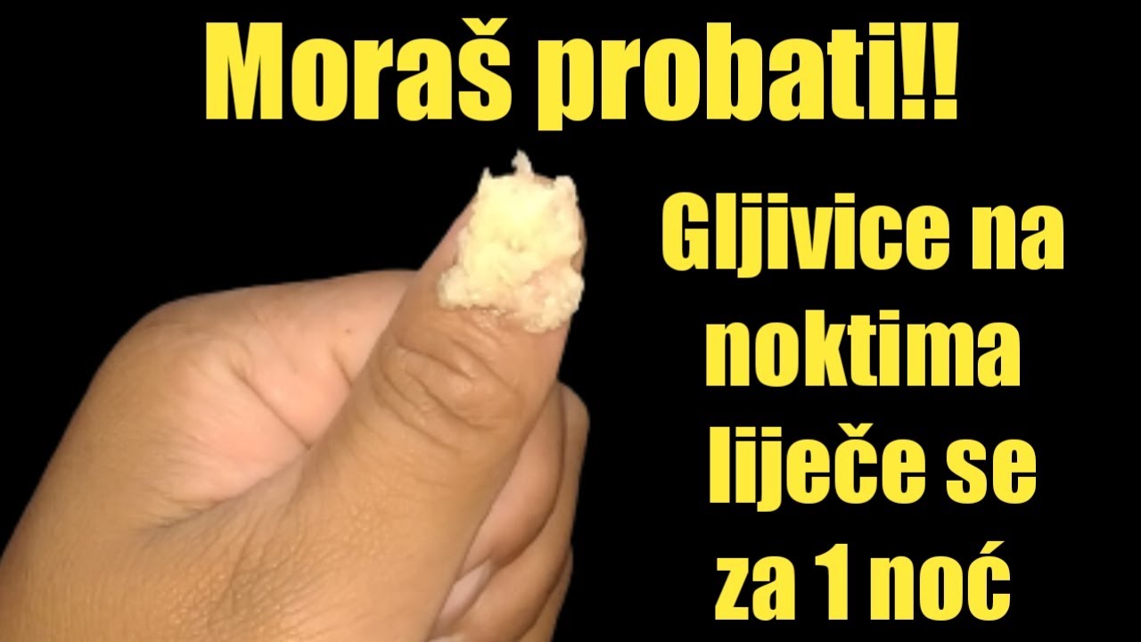 Gljivice na noktima liječe se za 1 noć, kako se riješiti gljivica na ...