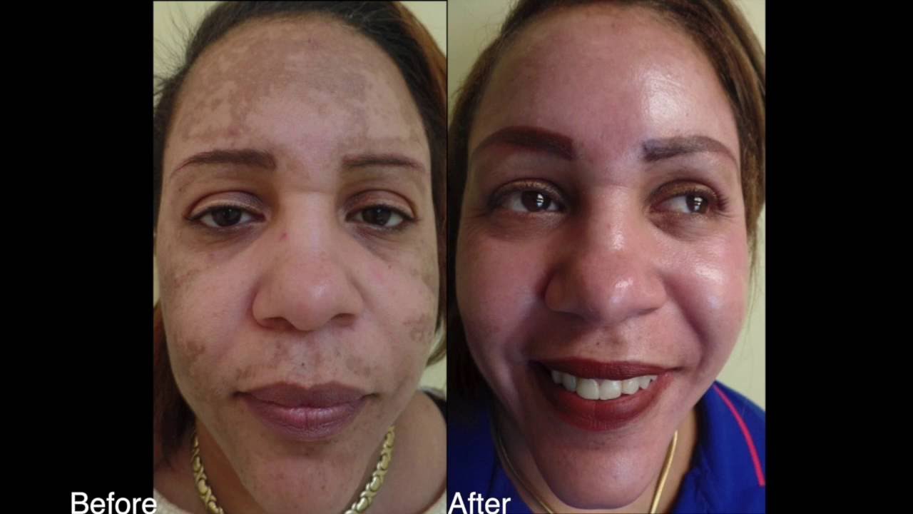 Severe melasma and aging skin treatment -Patient's testimony of Stone ...