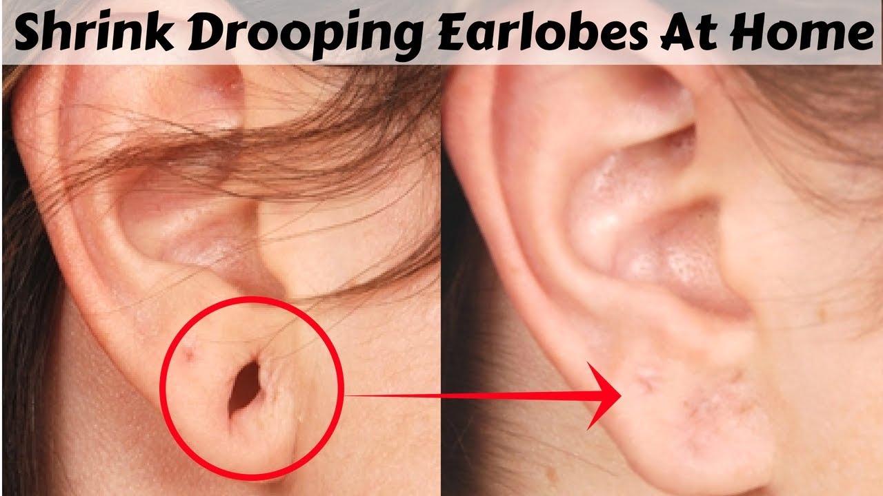 Top 3 Home Remedies To Shrink Drooping Earlobes | How To Shrink ...