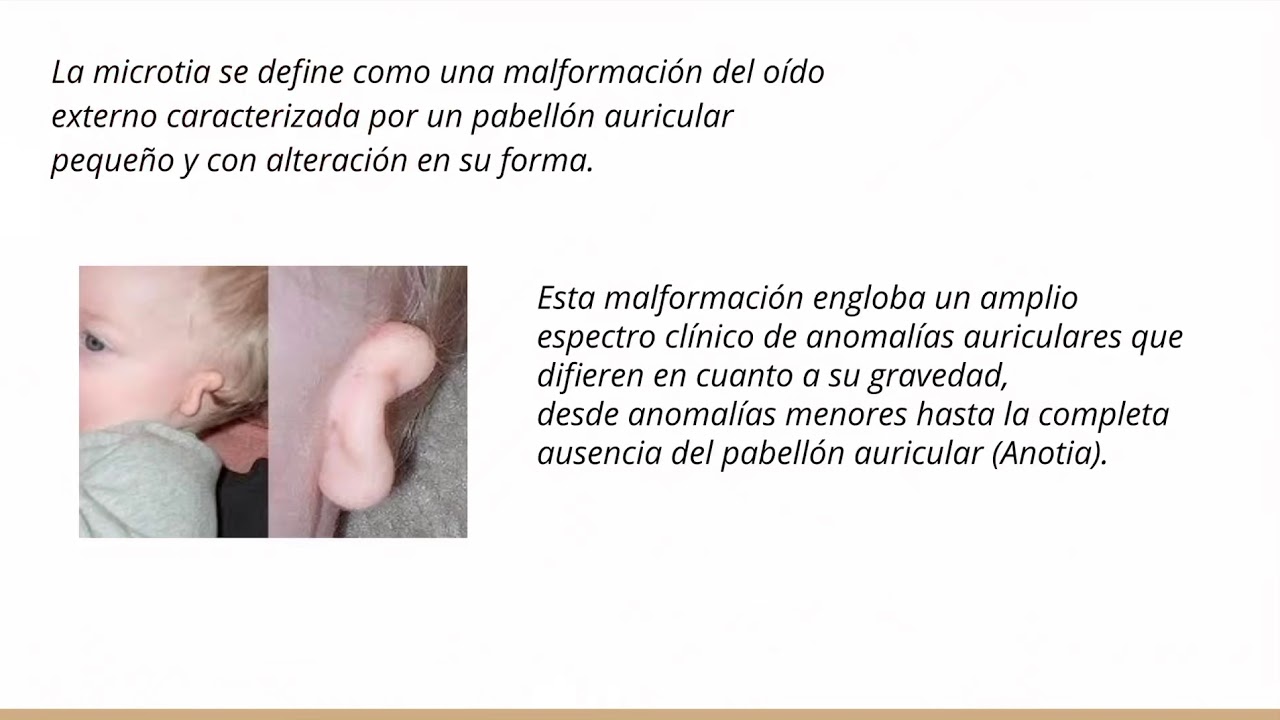 Microtia grado 3- Andrea Flores Villanueva - YouTube