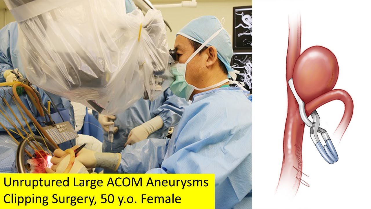 6. Unruptured Large ACOM Aneurysms Clipping Surgery, 50 y.o. Female ...
