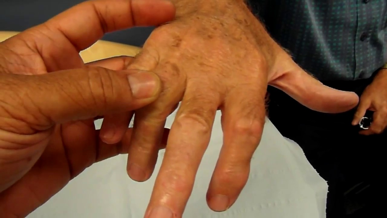 Bilateral Dupuytrens Right Hand Pre Manipulation - YouTube
