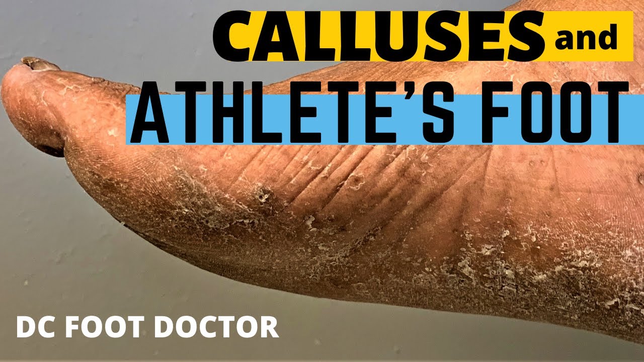 Calluses and Athlete's Foot, A Tough Combination - YouTube