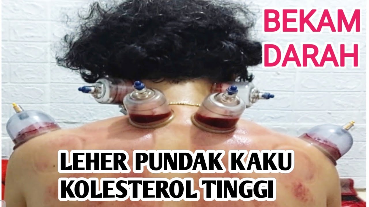 BEKAM DARAH PUNDAK LEHER KAKU DAN KOLESTEROL . @PIJAT & BEKAM TERDEKAT ...