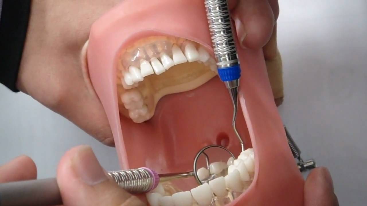 Maxillary Extraoral Fulcrum - YouTube