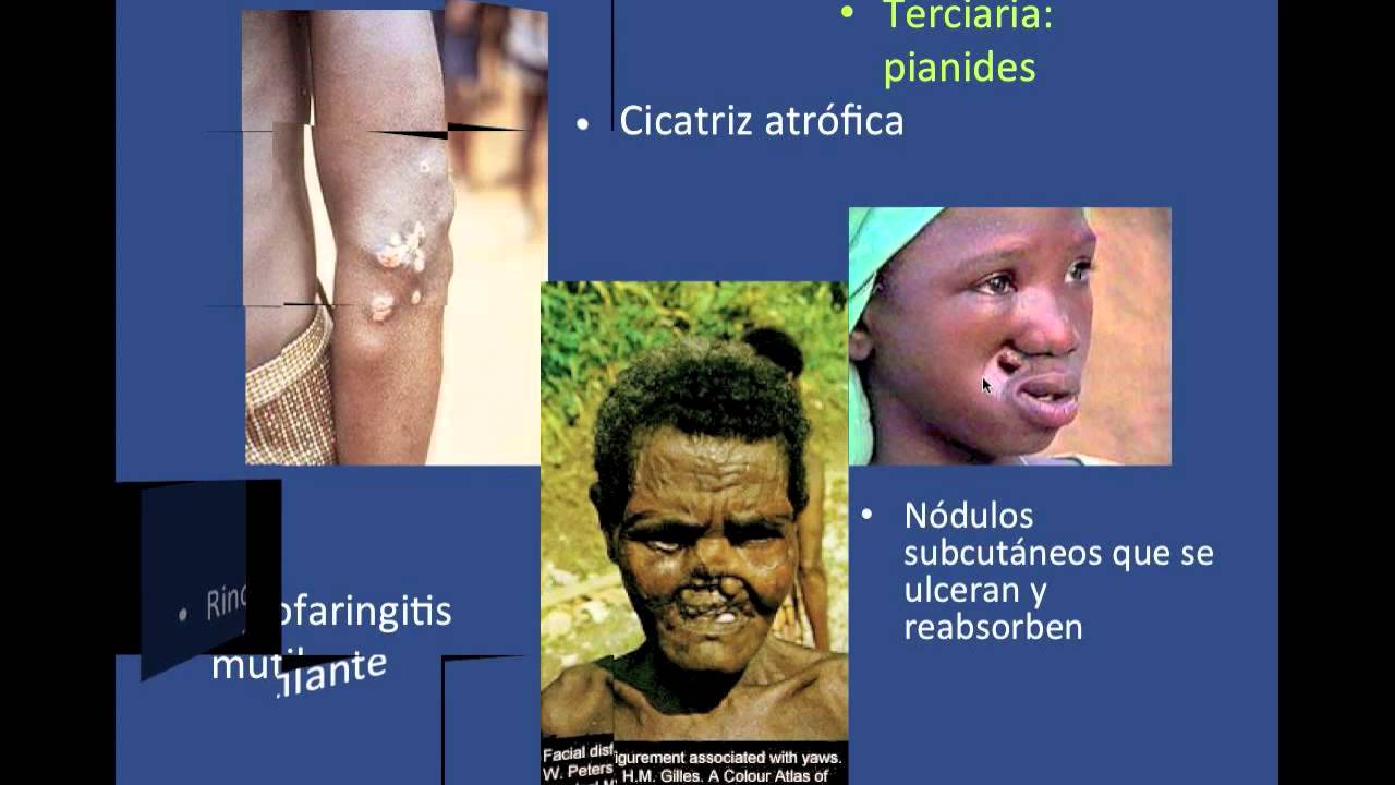 umh2658 2013-14 Lec57 Enfermedades bacteriana III Treponematosis ...