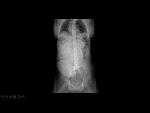 Cisto dermóide / teratoma - YouTube