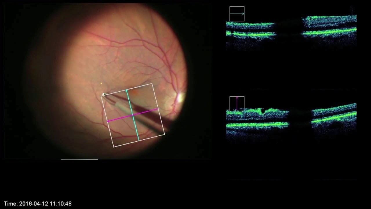 Intraoperative Optical Coherence Tomography in the Surgical Approach of ...