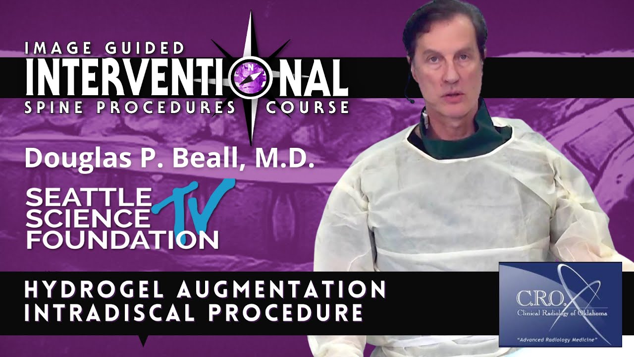 Hydrogel Augmentation Intradiscal Procedure - Douglas P. Beall, M.D ...