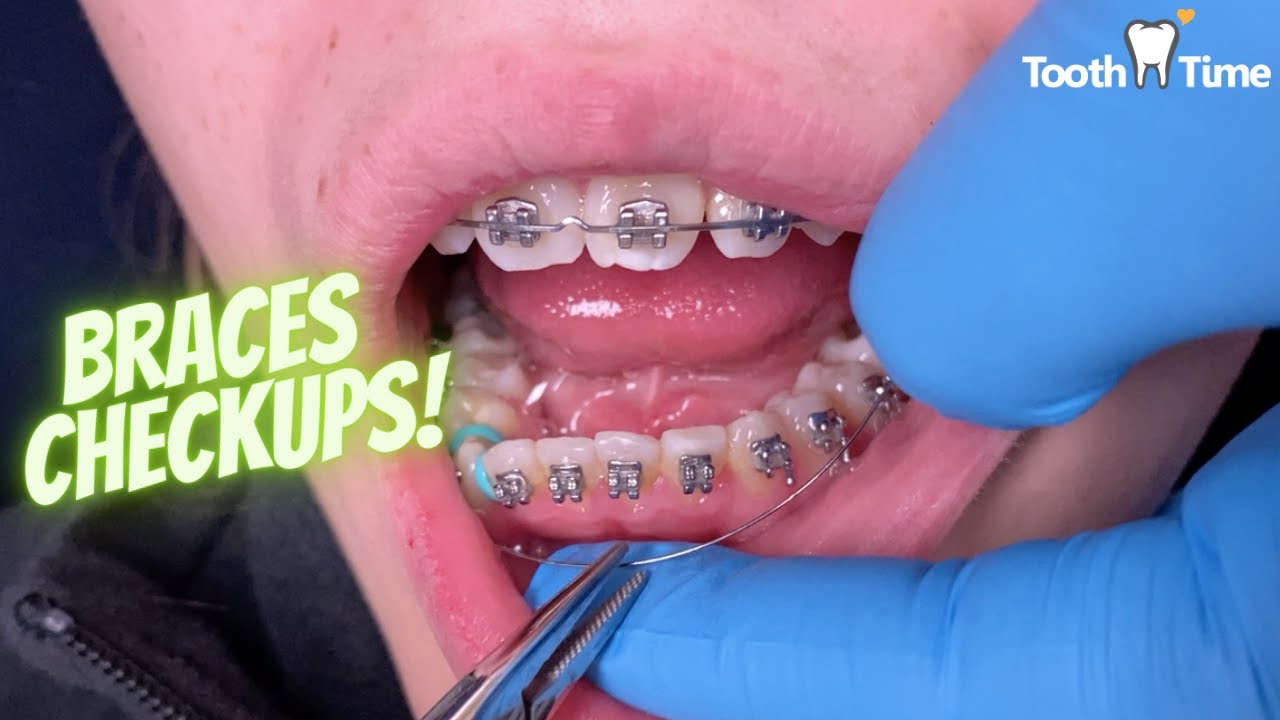 Braces Checkup - 9 months progress- Changing lower wire - Tooth Time ...
