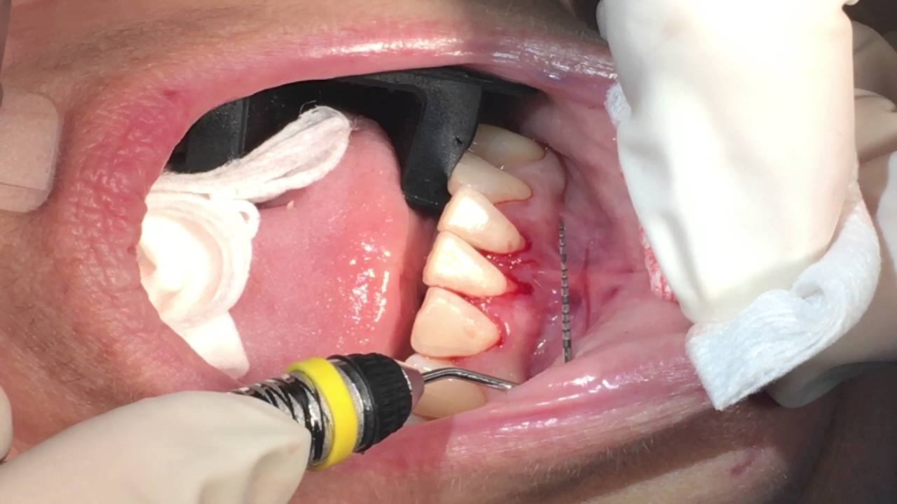 Frenectomy | Frenum Pull Surgery - YouTube