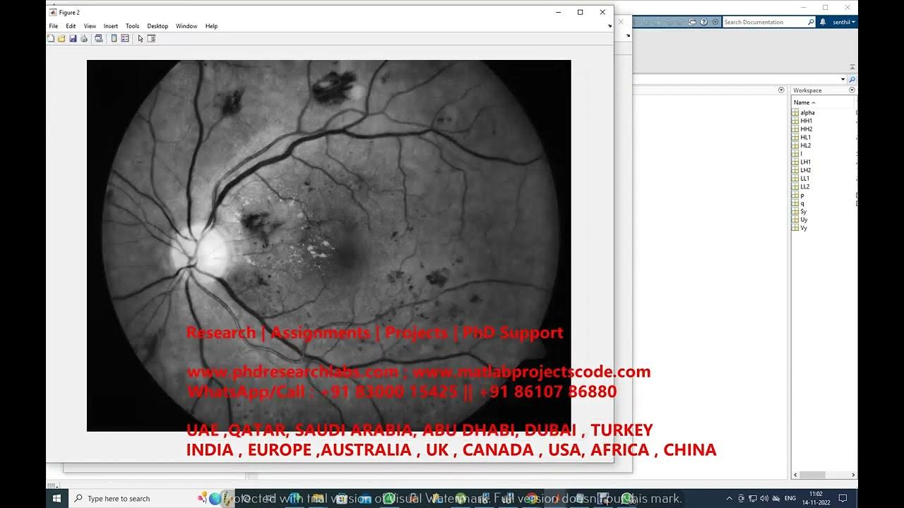 Diabetic Retinopathy SVM Microaneurysms & Hemorrhages Optic disc using ...