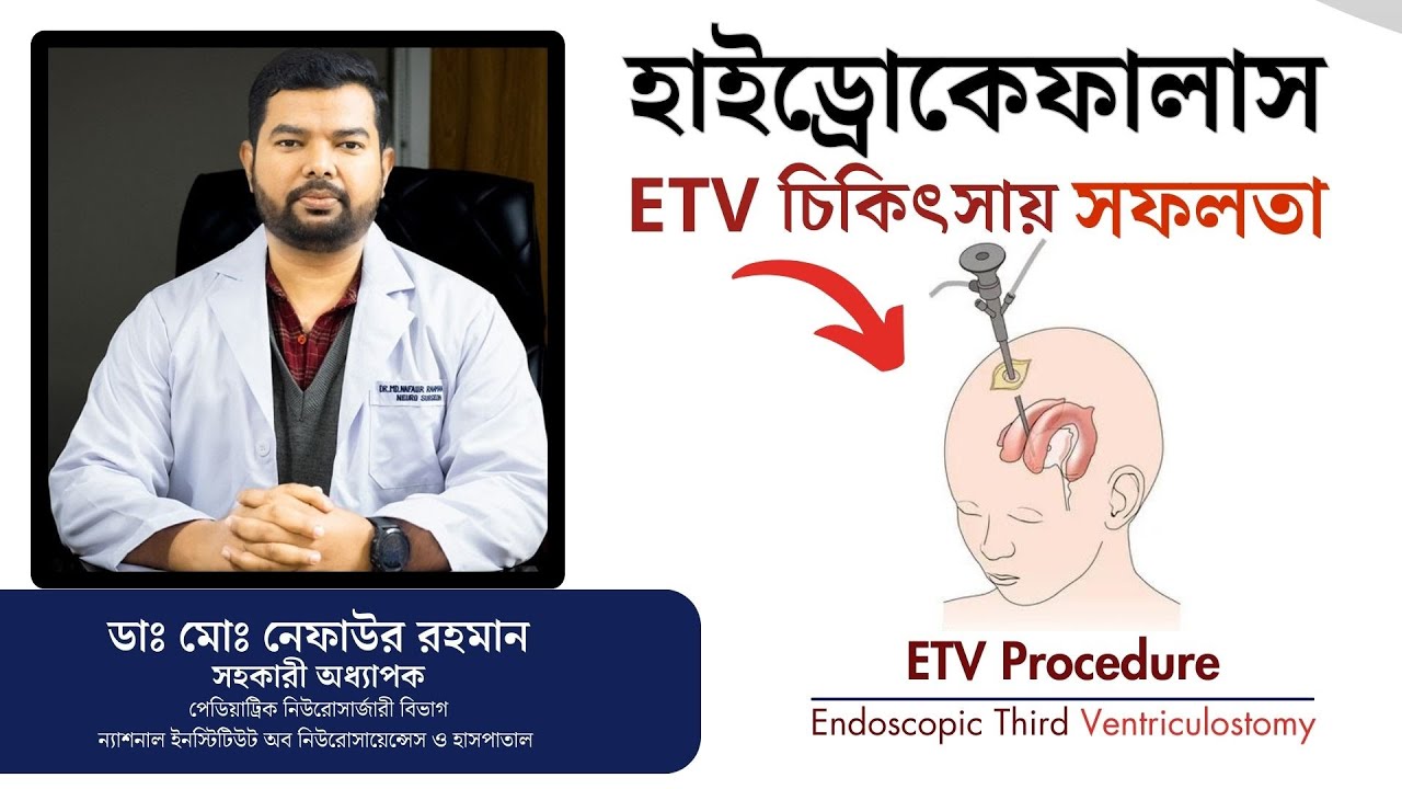 Success in ETV treatment for hydrocephalus || হাইড্রোকেফালাস ...