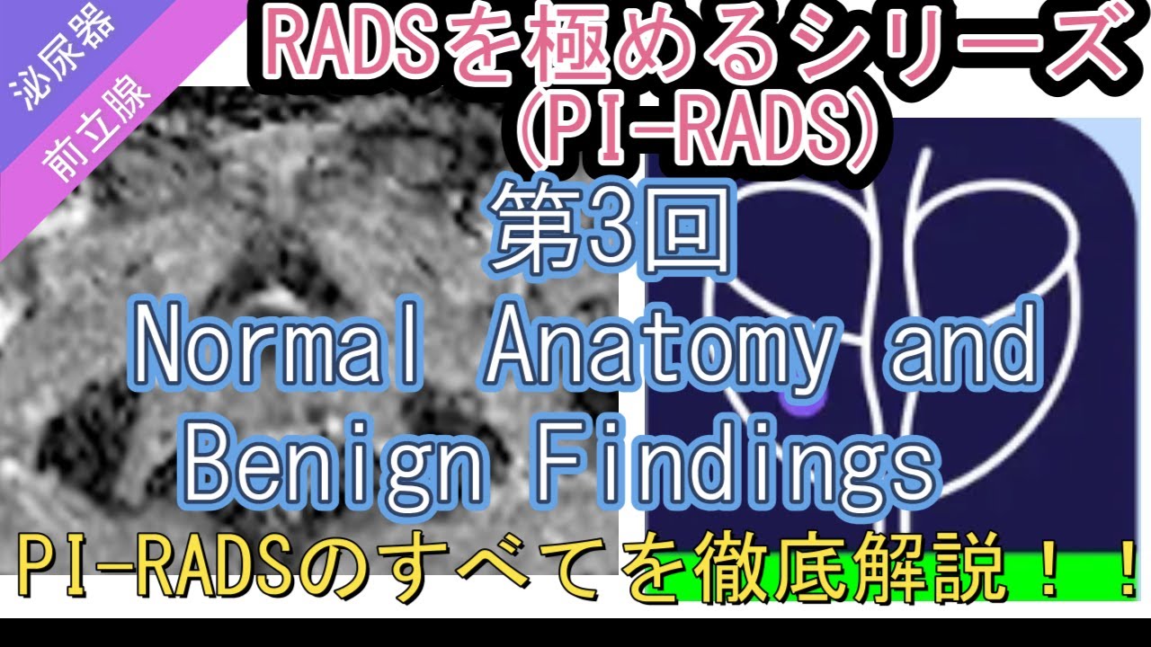 RADSを極めるシリーズ(PI-RADS)第3回 Normal Anatomy and Benign Findings - YouTube