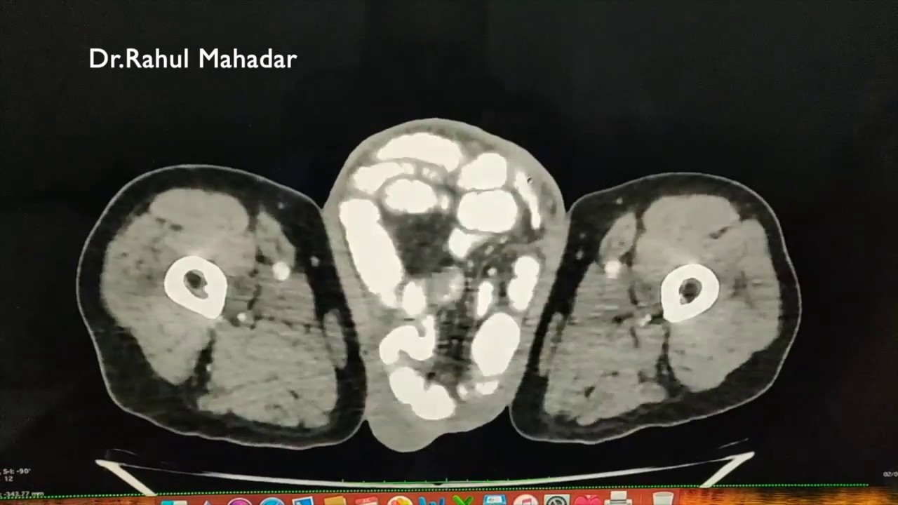 TAPP repair - For Large Recurrent B/L Inguinal Hernia - YouTube