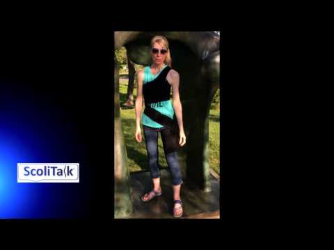 ScoliTalk: Project SAS 10  (Episode 2)