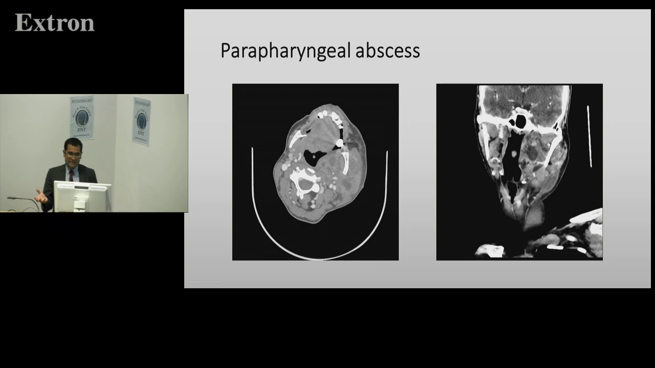 Deep Neck Space Infection - YouTube