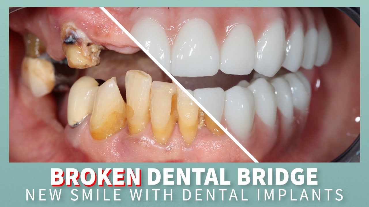 Broken Bridge: Smile Restored with a new smile on Innovative Dental ...
