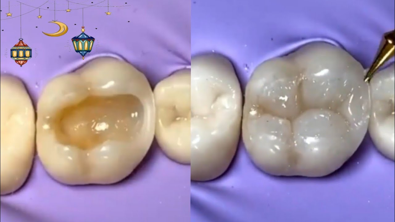 Class I Composite restoration - YouTube