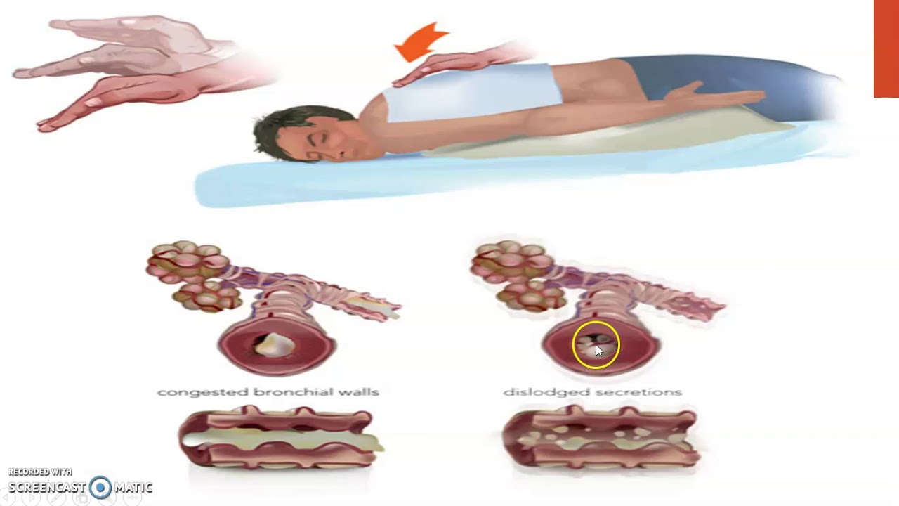 Postural Drainase - YouTube