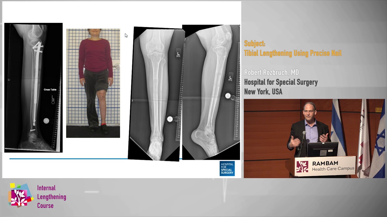 13 Tibial Lengthening Using Precise Nail - Robert Rozbruch MD. - YouTube