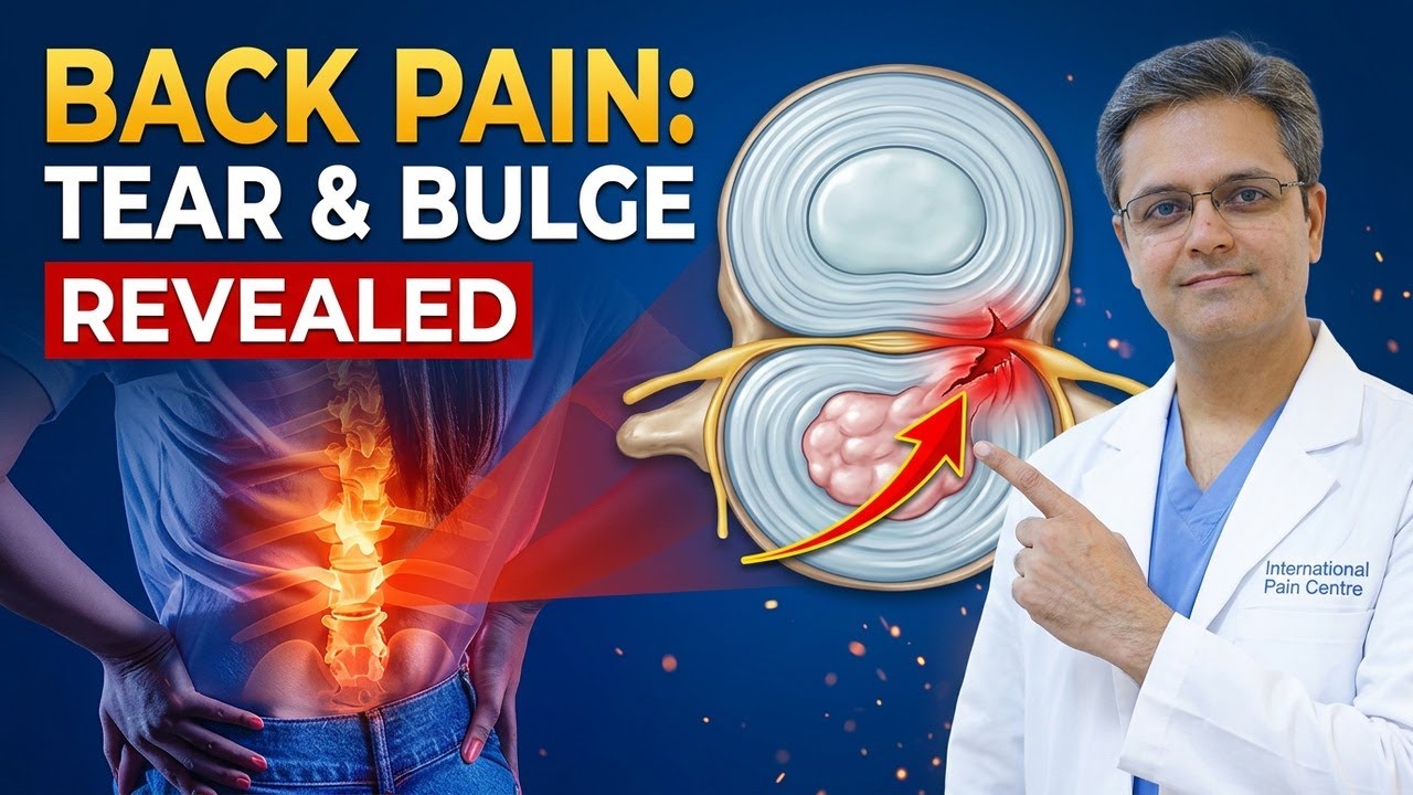Annular Tear (Disc Tear) Kya Hai? Disc Bulge, Back Pain, Healing ...