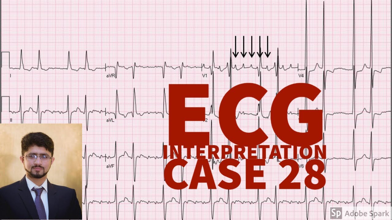 ECG MADE EASY CASE 28| ECG| EKG| ELECTROCARDIOGRAM| EDUCATIONAL VIDEO ...