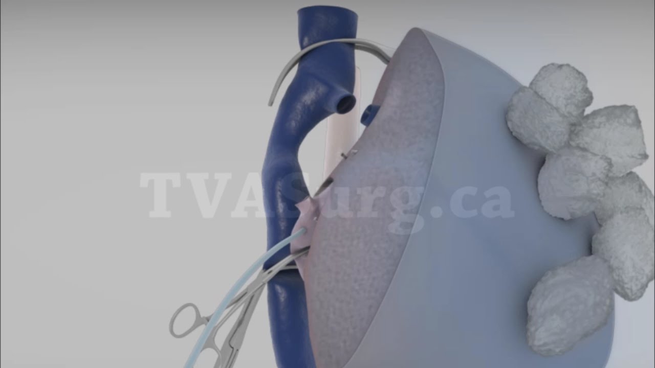 Extended right hepatectomy with in situ cold perfusion - YouTube