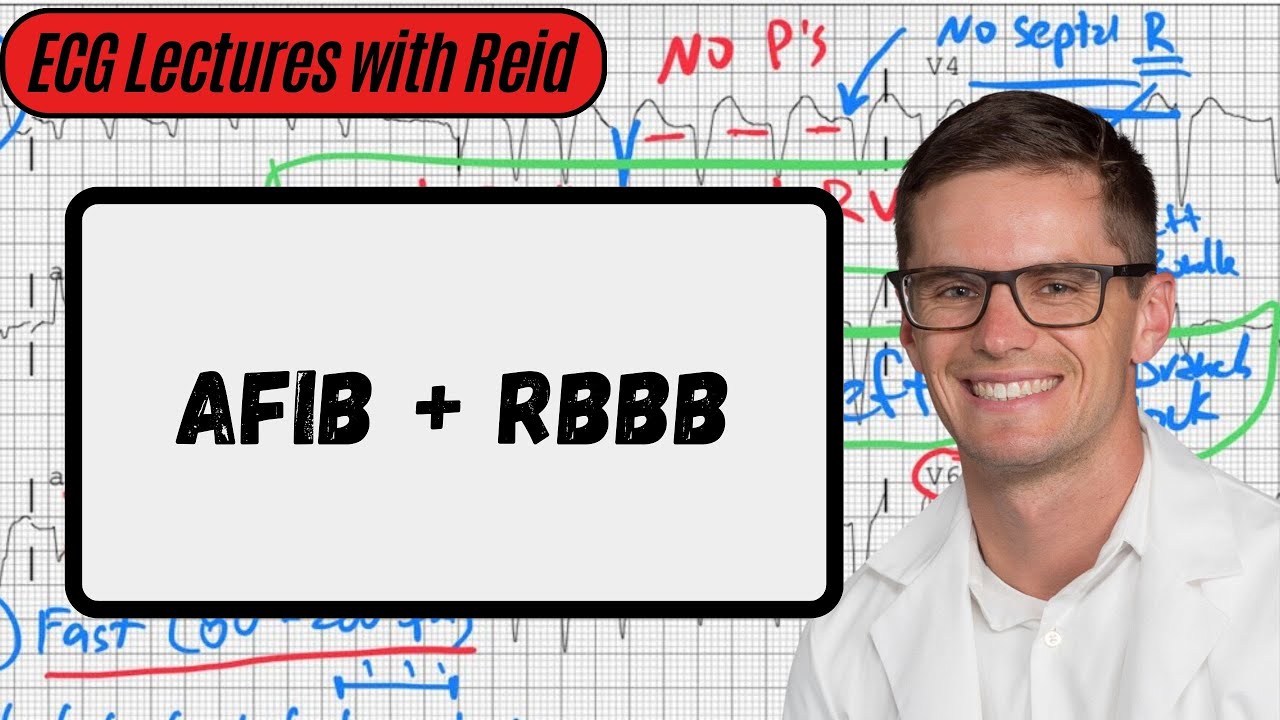 Atrial Fibrillation w/ Right Bundle Branch Block | Day 15 ECG Challenge ...