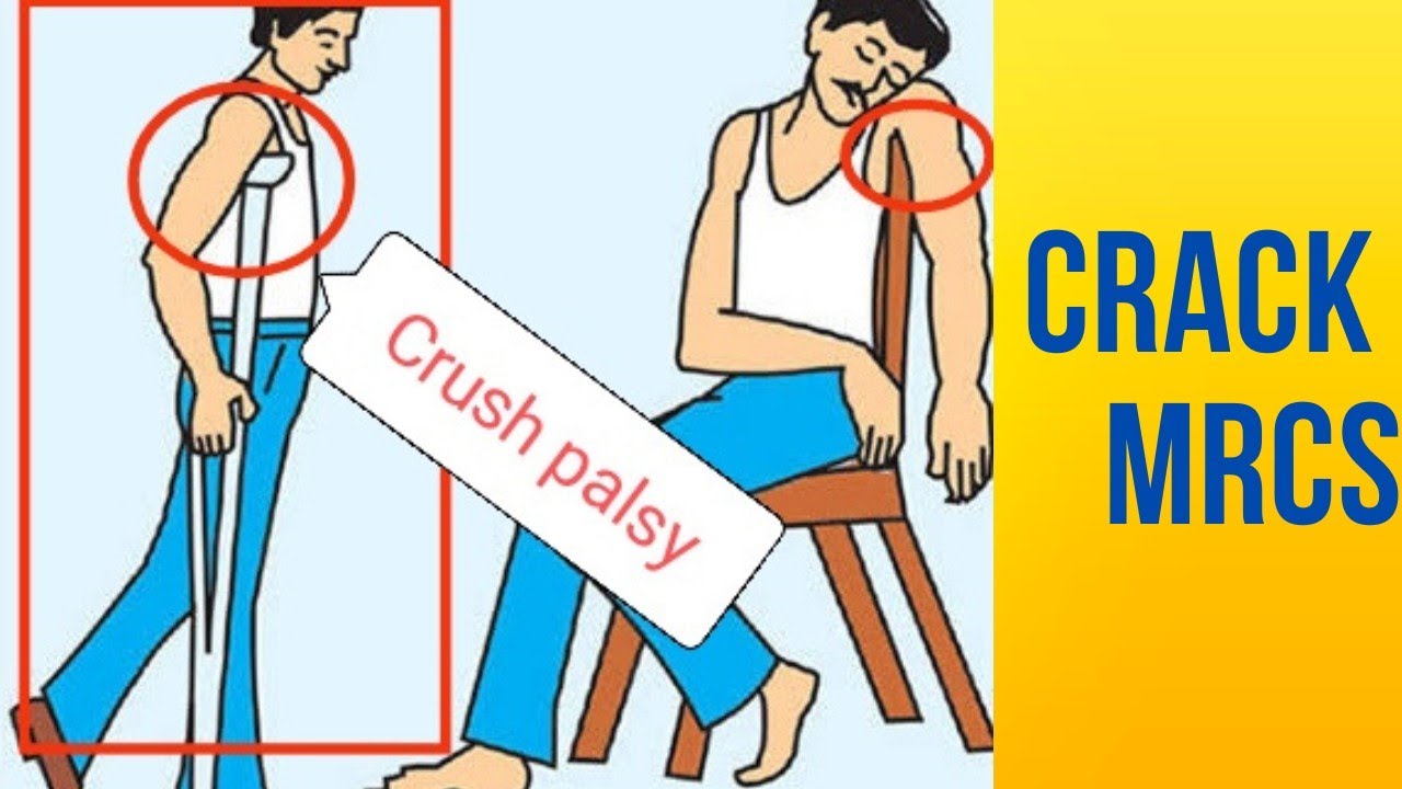 Crush palsy nerve injury MRCS question solve (CRACK MRCS) - YouTube