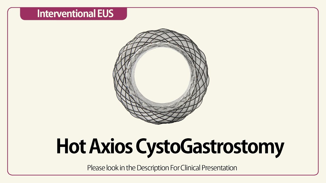 Linear EUS: Hot Axios CystoGastrostomy - YouTube