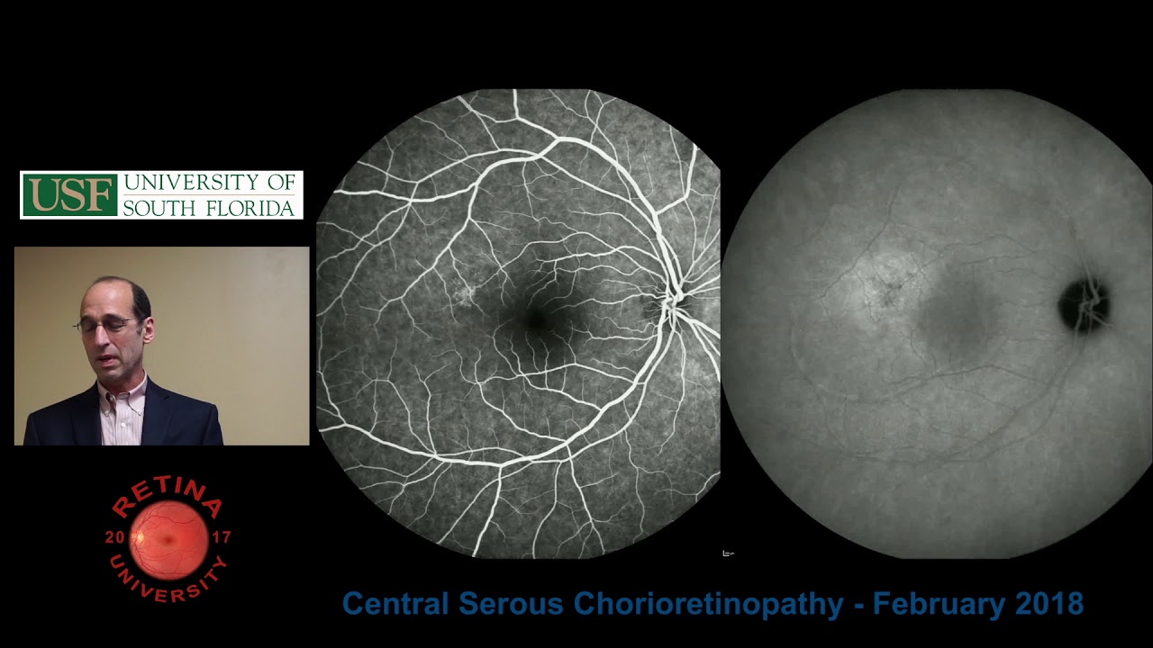 Central Serous Chorioretinopathy - YouTube