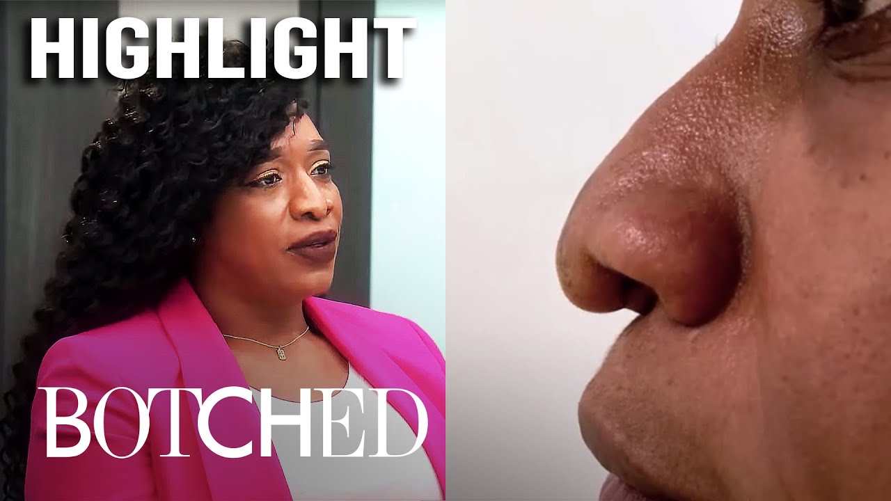 Bad Nose Job Before And After