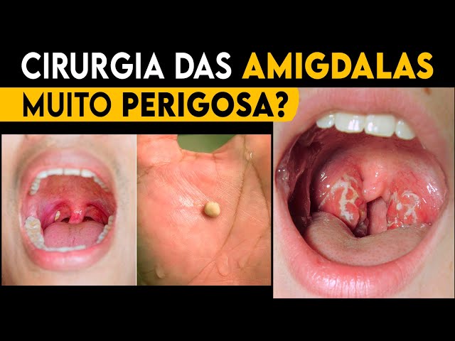 Classificacao De Amigdalite Amigdalite | Dicionário Infopédia De